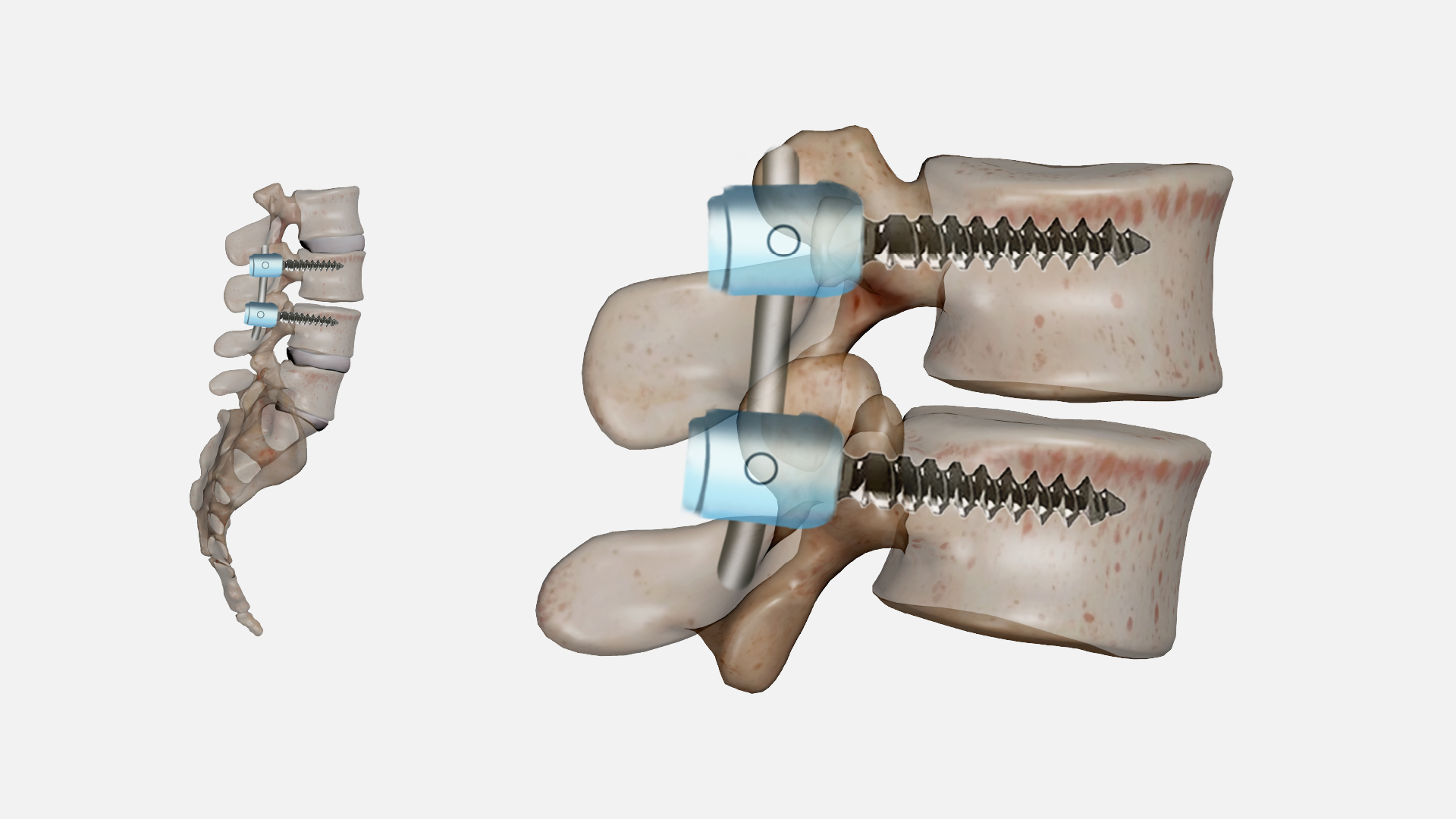 Spinal Fusion Surgery: Detailed Overview - Liva Hospital
