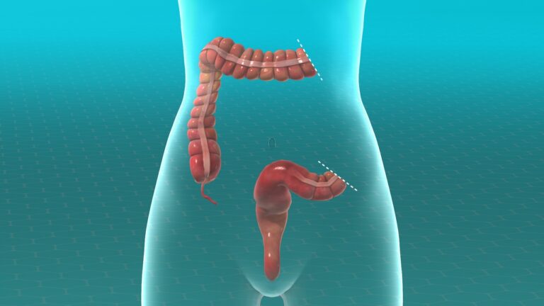 The Importance of Colectomy Surgery - Liva Hospital