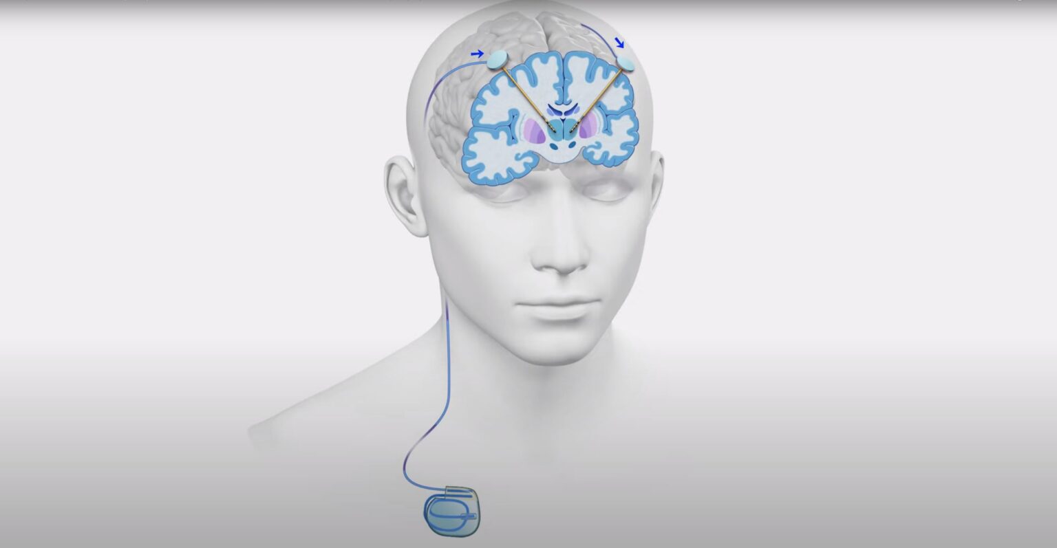 Deep Brain Stimulation: Indications and Complications - Liva Hospital