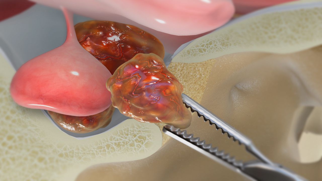 Tumor Resection Surgery: A Detailed Overview - Liva Hospital