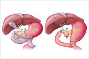All You Need to Know About Whipple Surgery - Liva Hospital
